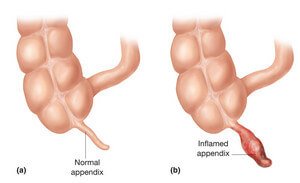 Appendix Pain - Location, Causes, Diagnosis, Treatment, Surgery