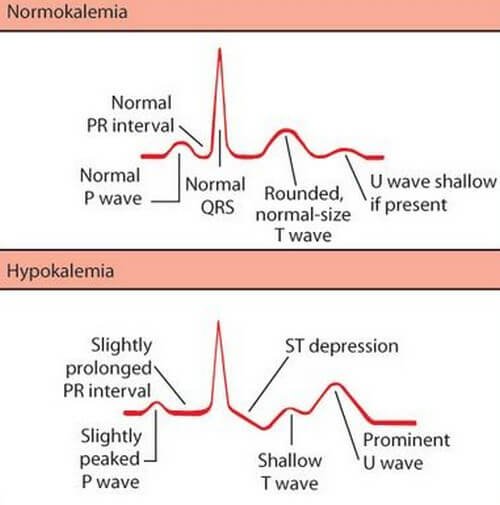 Hypokalemia Symptoms Causes Ecg And Treatment Health Blog