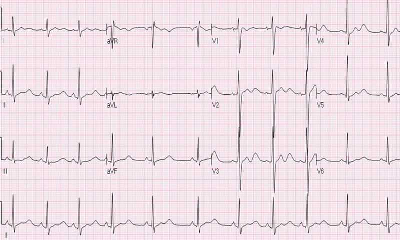Hypokalemia Symptoms Causes Ecg And Treatment Health Blog
