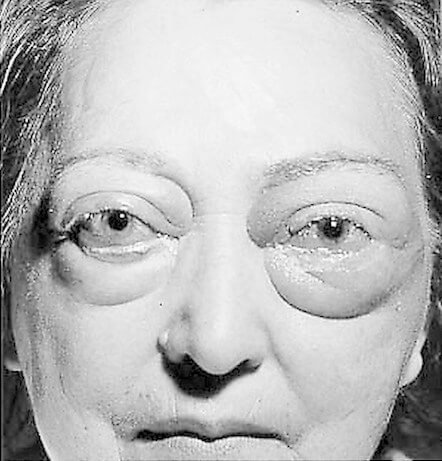 Periorbital edema - Causes and Treatment : Health Blog